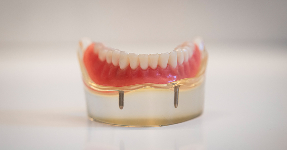 Zahnprothesen: Infos, Arten, Kosten - Zahnklinik ABC Bogen